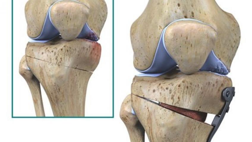Bow Legged Correction Surgery