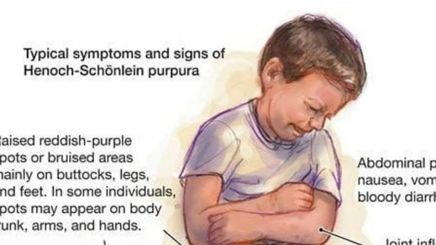 Henoch Schonlein Purpura Symptoms