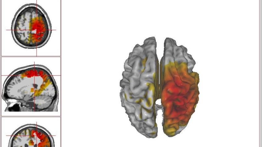 acquired brain injury/anoxic brain injury - a Personal Causes ...